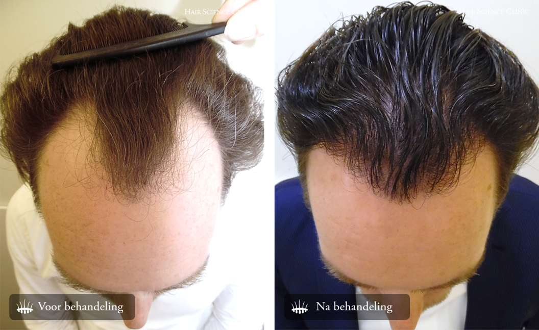 Haartransplantation für Männer | HST-methode | Hair Science Institute